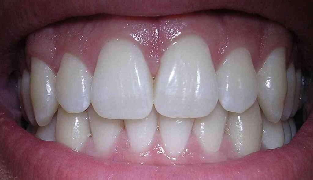 The silent agony of temperature-sensitive teeth: Understanding and ...